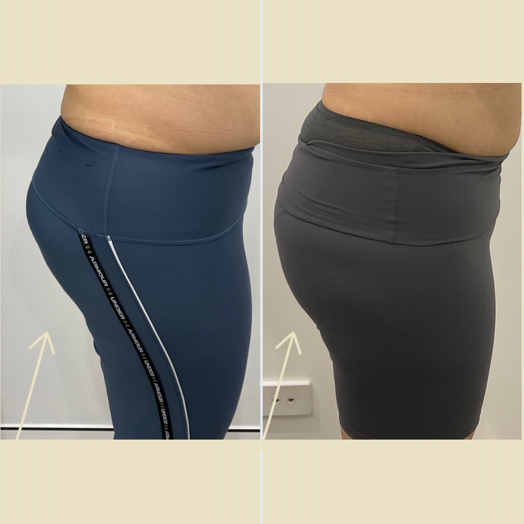 SculptX + EMS – Medlaser – Pre-owned Aesthetic Devices Marketplace