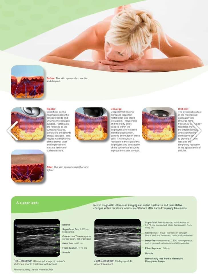 Alma laser – Medlaser – Pre-owned Aesthetic Devices Marketplace