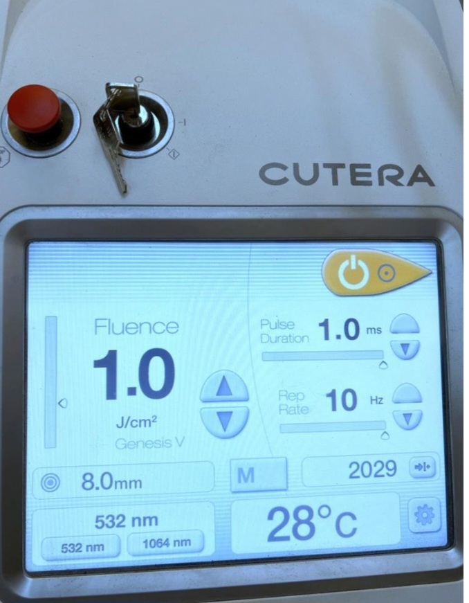 Cutera Excel V Plus As New Condition 2021 M/Y (SOLD) – Medlaser – Pre ...